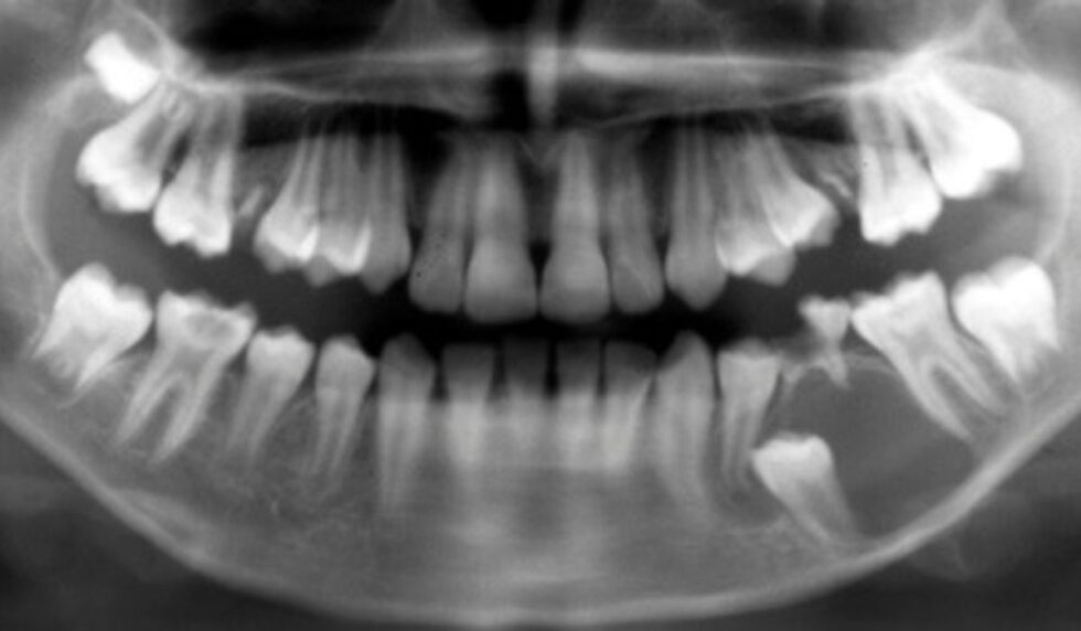 ¿Qué es un quiste dentígero y cómo se trata?